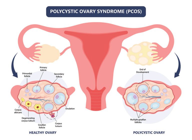 Policistični jajnici, sindrom policističnih jajnika i insulinska rezistencija – sve češći ...